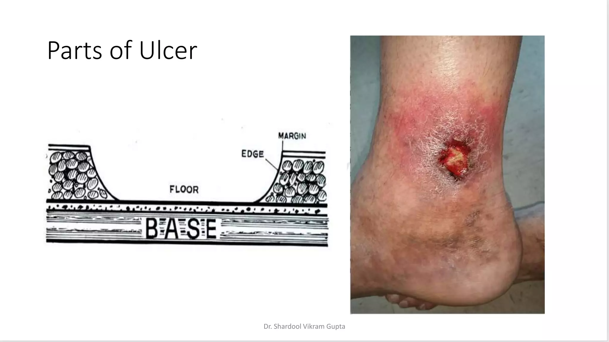 Examination of ulcer