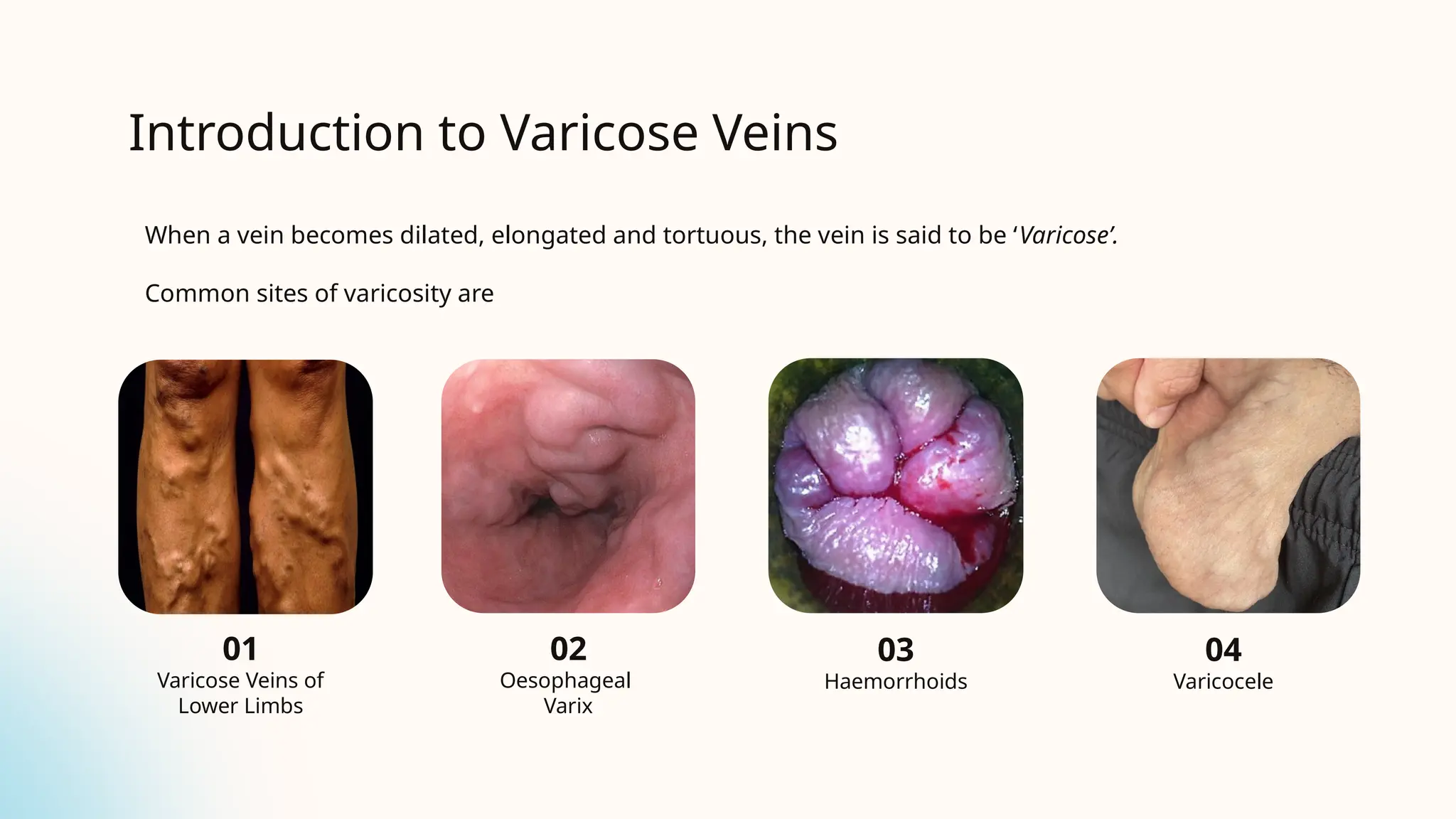 Examination of Varicose Veins & its Radiological Findings | PPTX