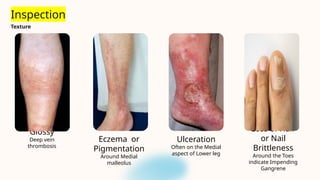 Examination of Varicose Veins & its Radiological Findings | PPTX