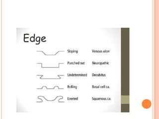 Examinatyion of ulcer | PPTX