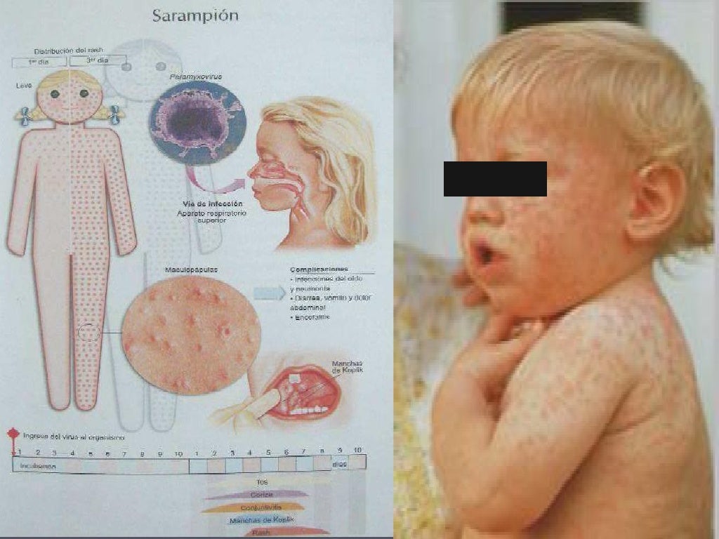 Exantemas en pediatría