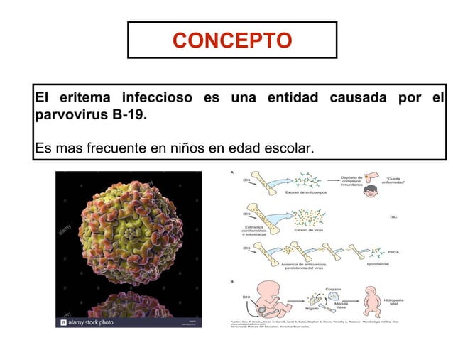 Exantema subito y eritema infeccioso | PPTX