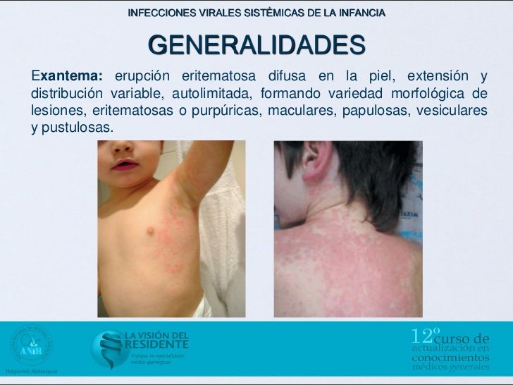 Exantemas virales