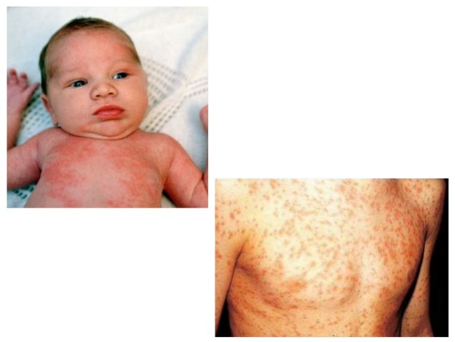 Enfermedades exantematicas en la infancia. Rubeola, sarampion, varice…