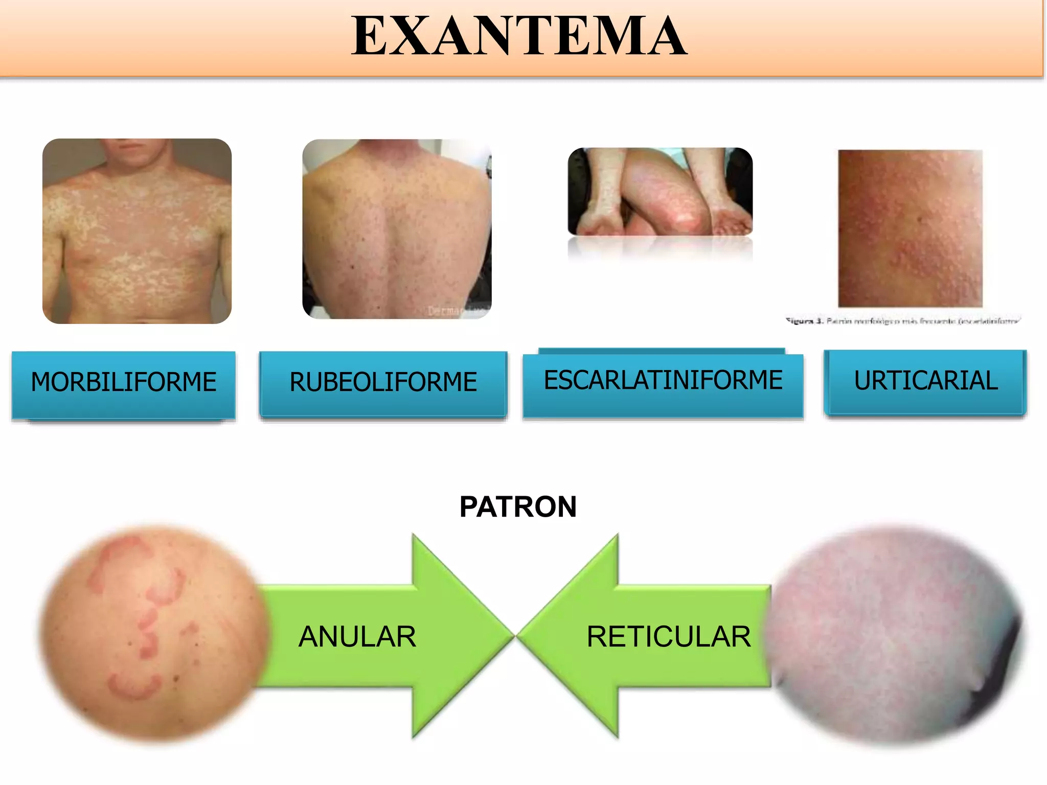 Exantematicas pediatria | PPTX | Infectious Diseases | Diseases and ...