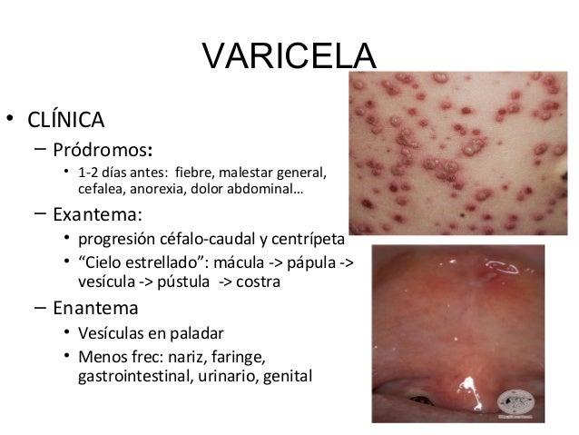 (2016.06.07) - Exantema y fiebre en paciente pediátrico. (PPT)