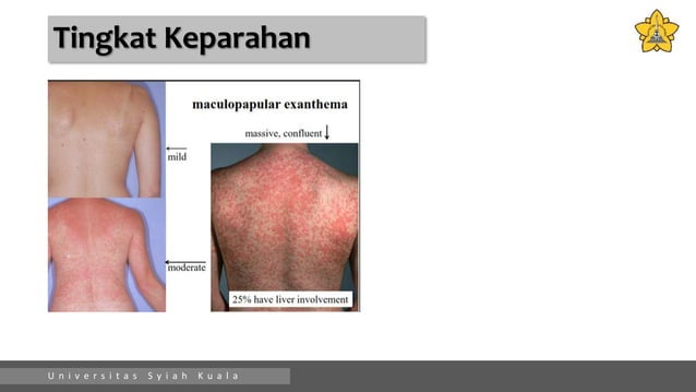 Exanthema Eruption.pptx