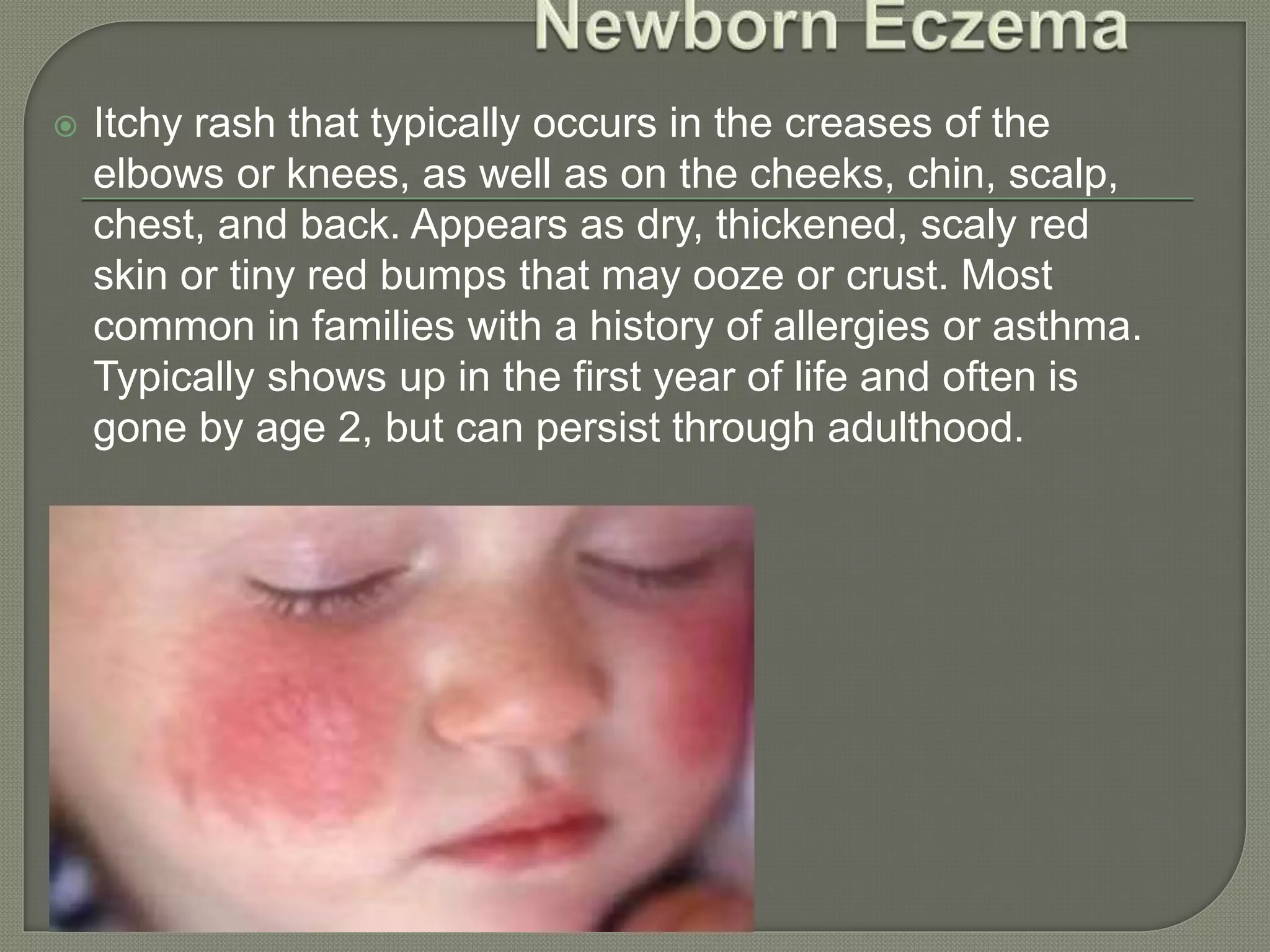 Exanthema (rash) in pakistan | PPT