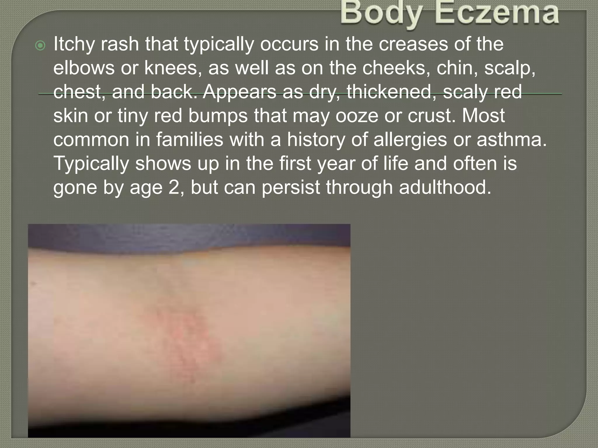 Exanthema (rash) in pakistan | PPT