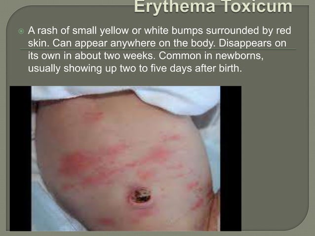 Exanthema (rash) in pakistan | PPT