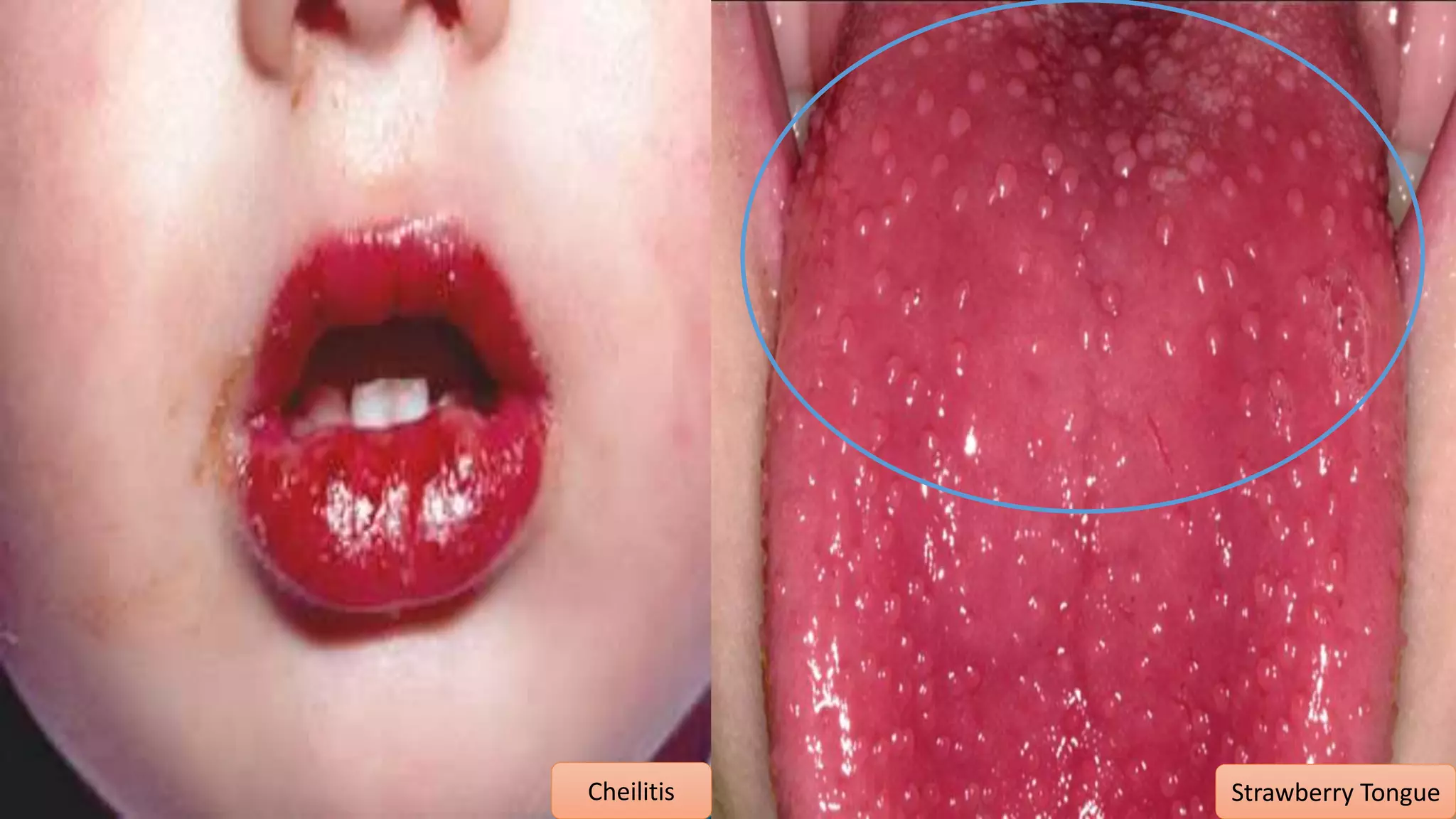 rash, exanthem, approach to exanthem, maculopapular exanthem, Exanthem ...