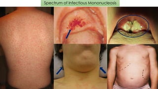rash, exanthem, approach to exanthem, maculopapular exanthem, Exanthem ...