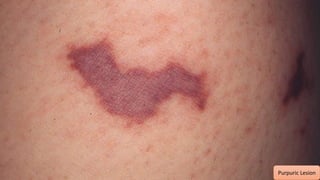 rash, exanthem, approach to exanthem, maculopapular exanthem, Exanthem ...