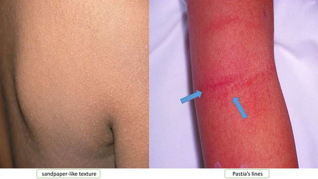 rash, exanthem, approach to exanthem, maculopapular exanthem, Exanthem ...