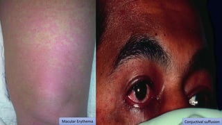 rash, exanthem, approach to exanthem, maculopapular exanthem, Exanthem ...