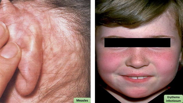 rash, exanthem, approach to exanthem, maculopapular exanthem, Exanthem ...