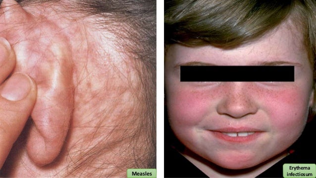 Rash Exanthem Approach To Exanthem Maculopapular