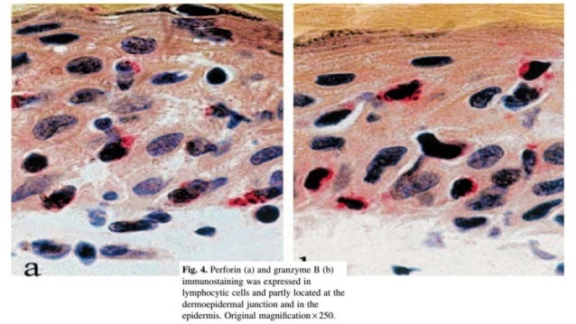 rash, exanthem, approach to exanthem, maculopapular exanthem, Exanthe…