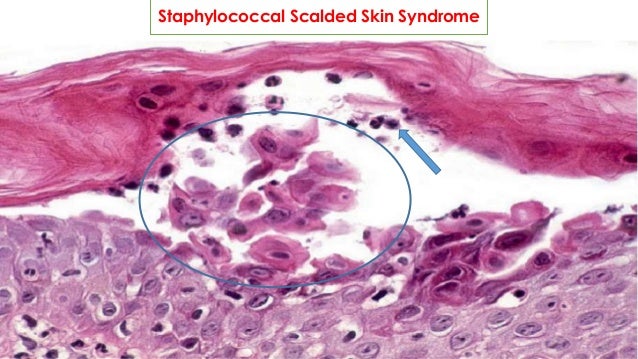 Rash Exanthem Approach To Exanthem Maculopapular