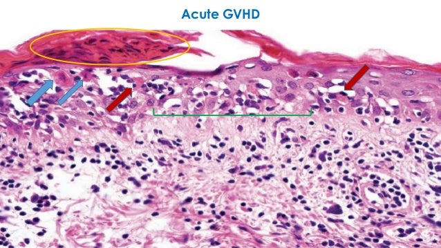 rash, exanthem, approach to exanthem, maculopapular exanthem, Exanthe…