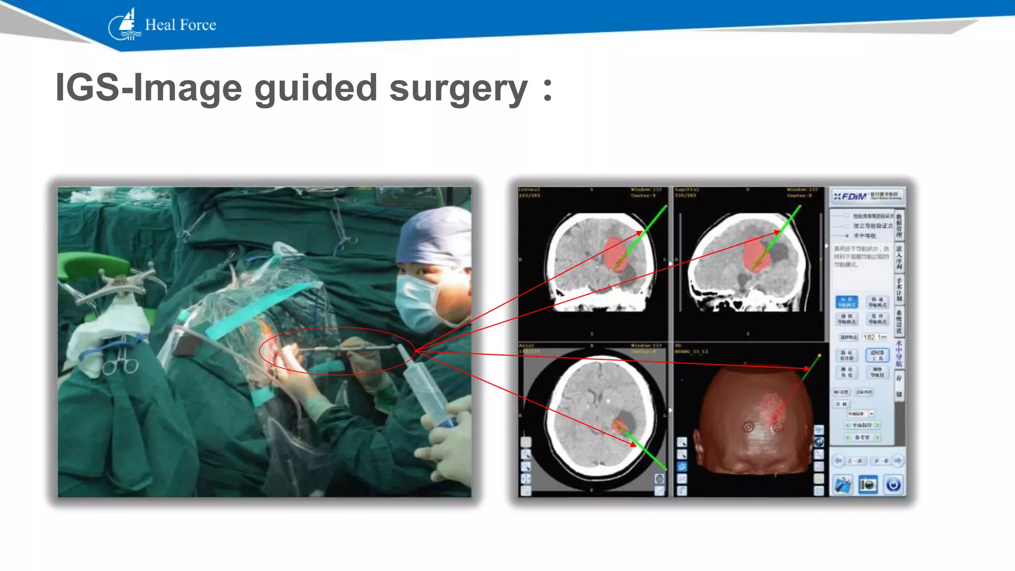 Heal Force: Excelim 04 Image guided Surgery for cranial and ENT ...