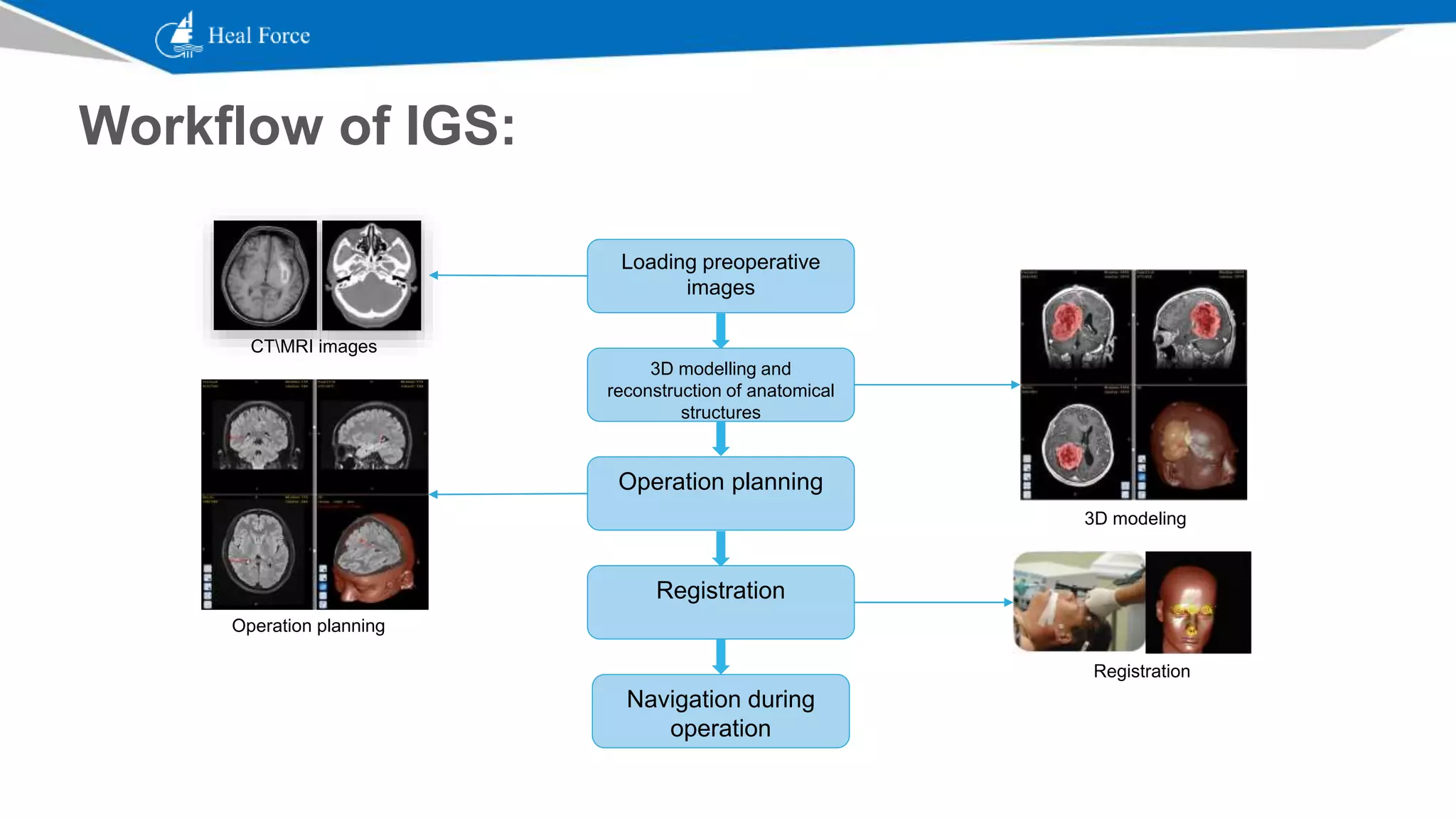 Heal Force: Excelim 04 Image guided Surgery for cranial and ENT ...