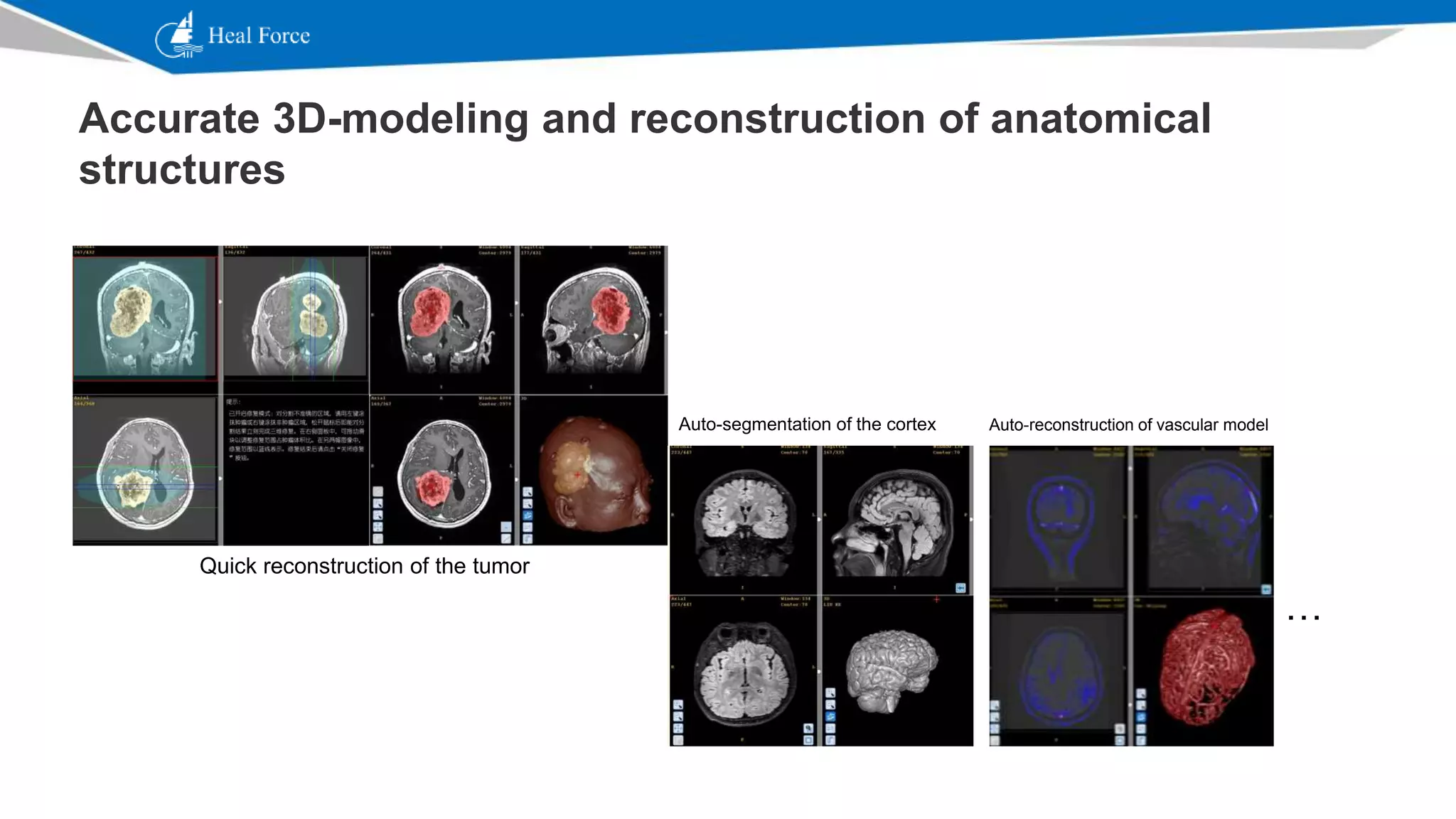 Heal Force: Excelim 04 Image guided Surgery for cranial and ENT ...
