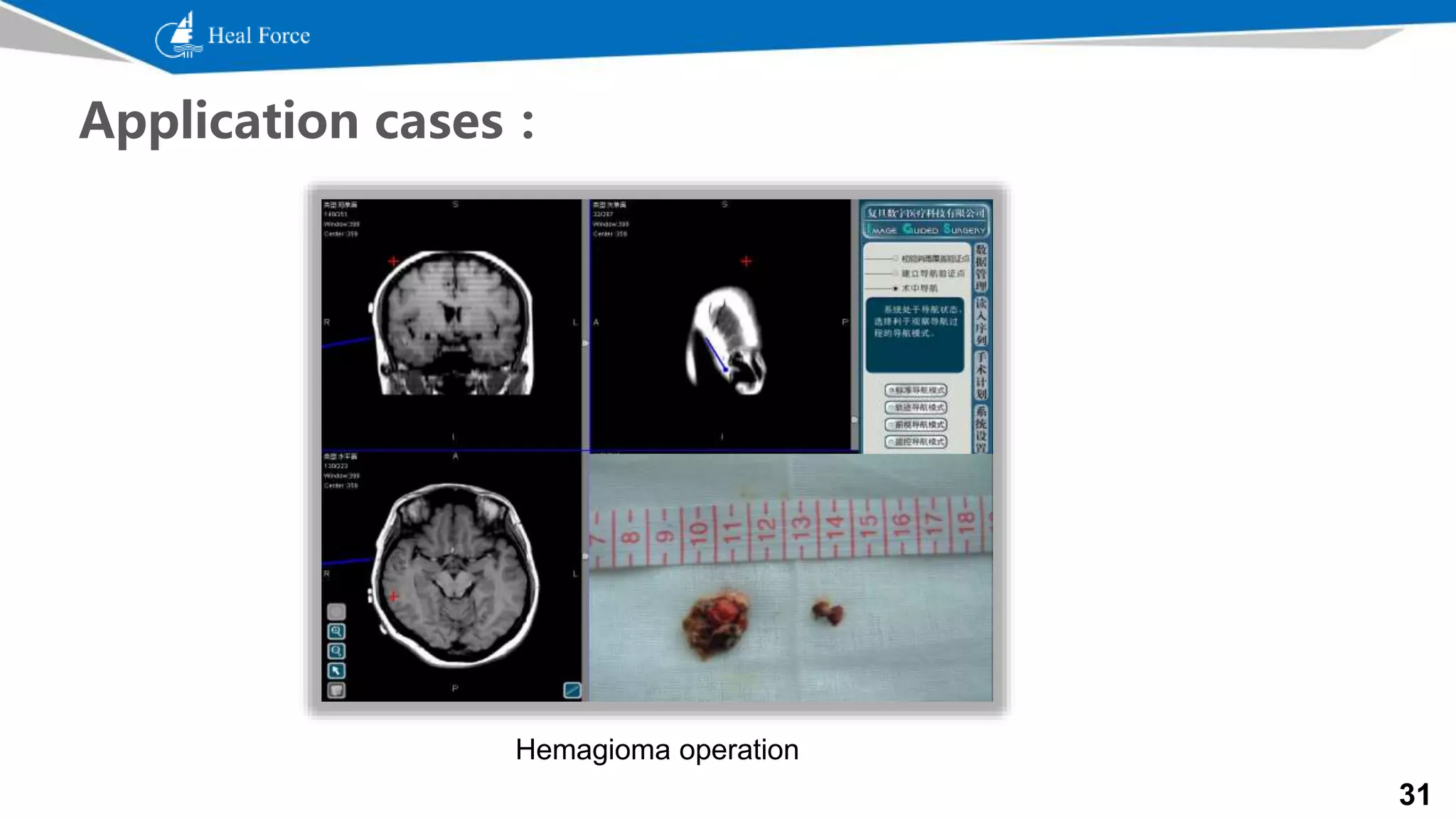 Heal Force: Excelim 04 Image guided Surgery for cranial and ENT ...