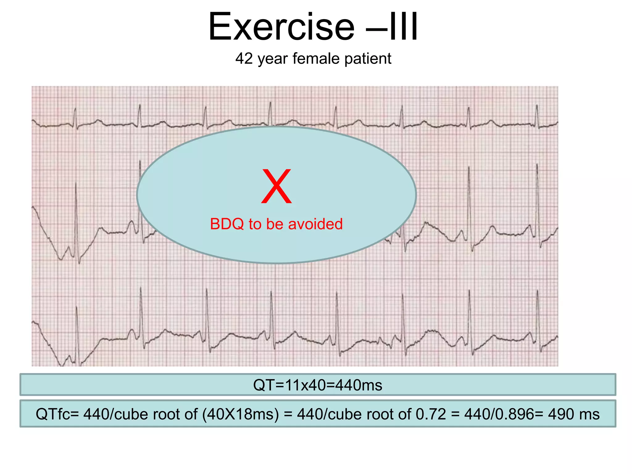 Excercise corrected qt interval (q tc) ecg interpretation | PPTX ...
