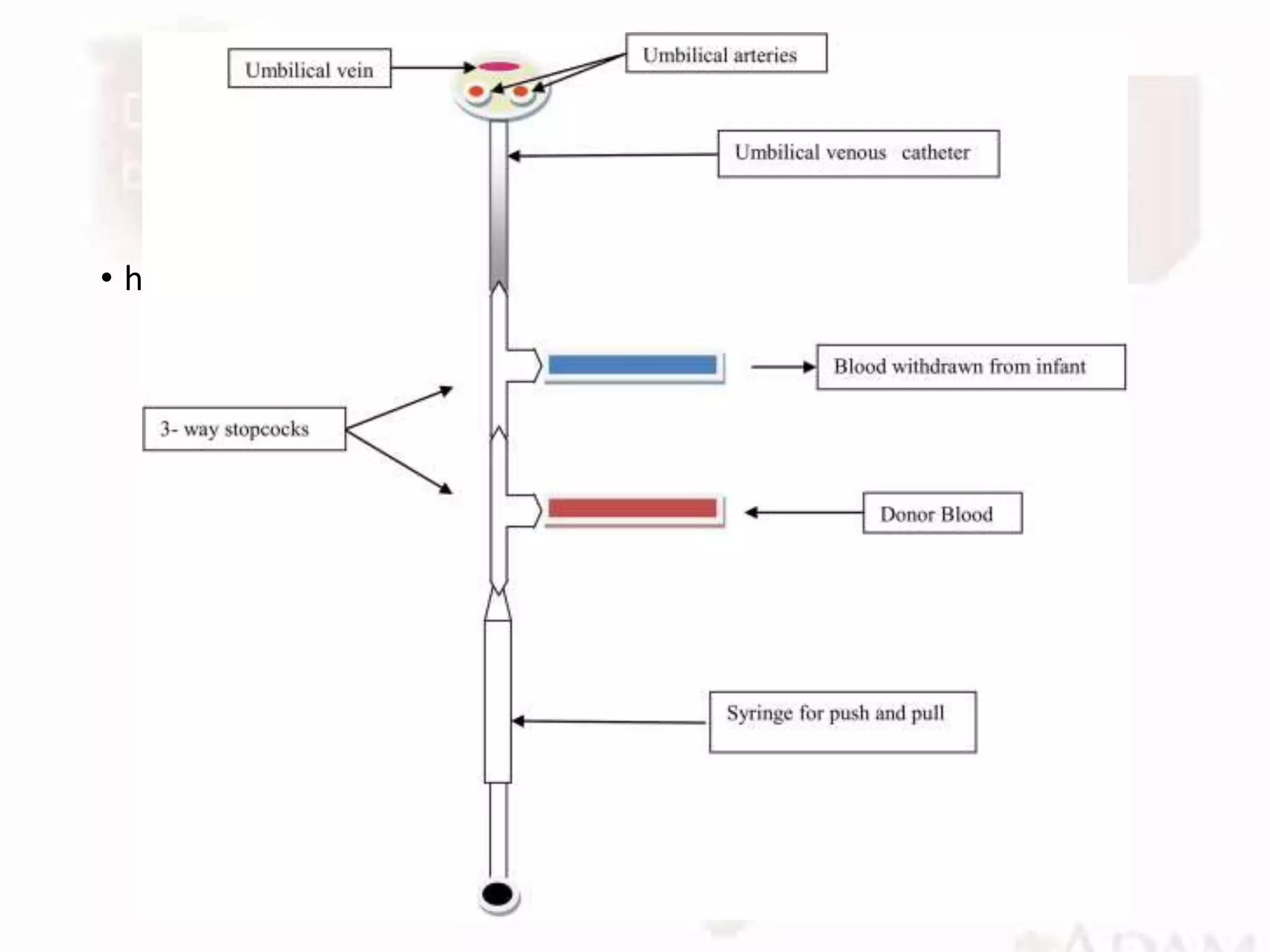 Exchange blood transfusion | PPTX