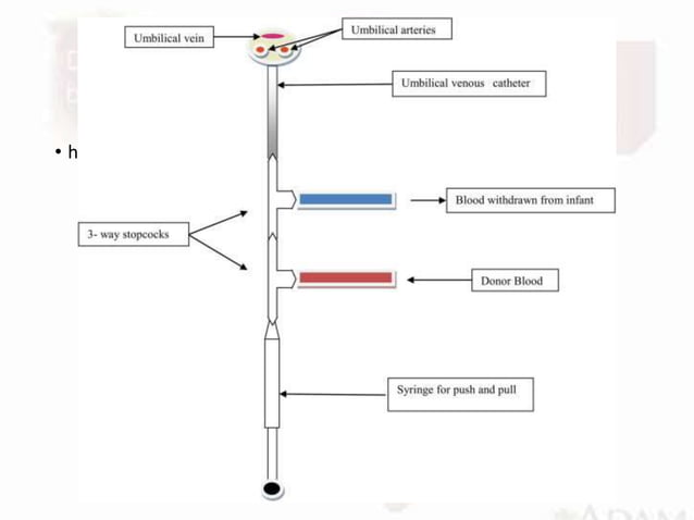 Exchange blood transfusion | PPTX | Blood Disorders | Diseases and ...