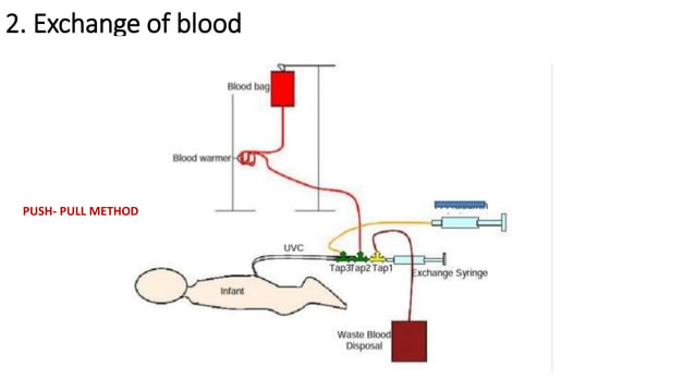 Exchange transfusion