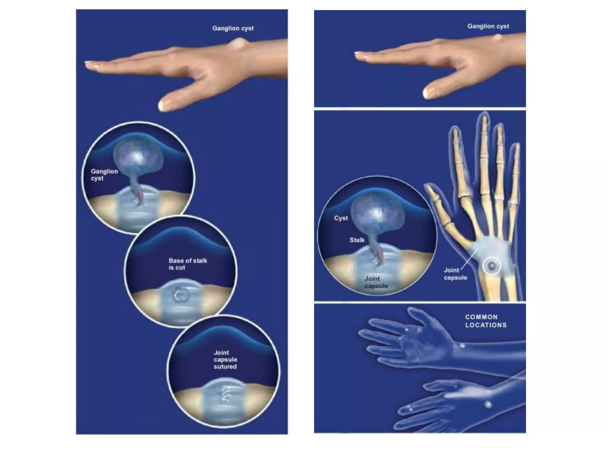 Excision of a ganglion | PPTX