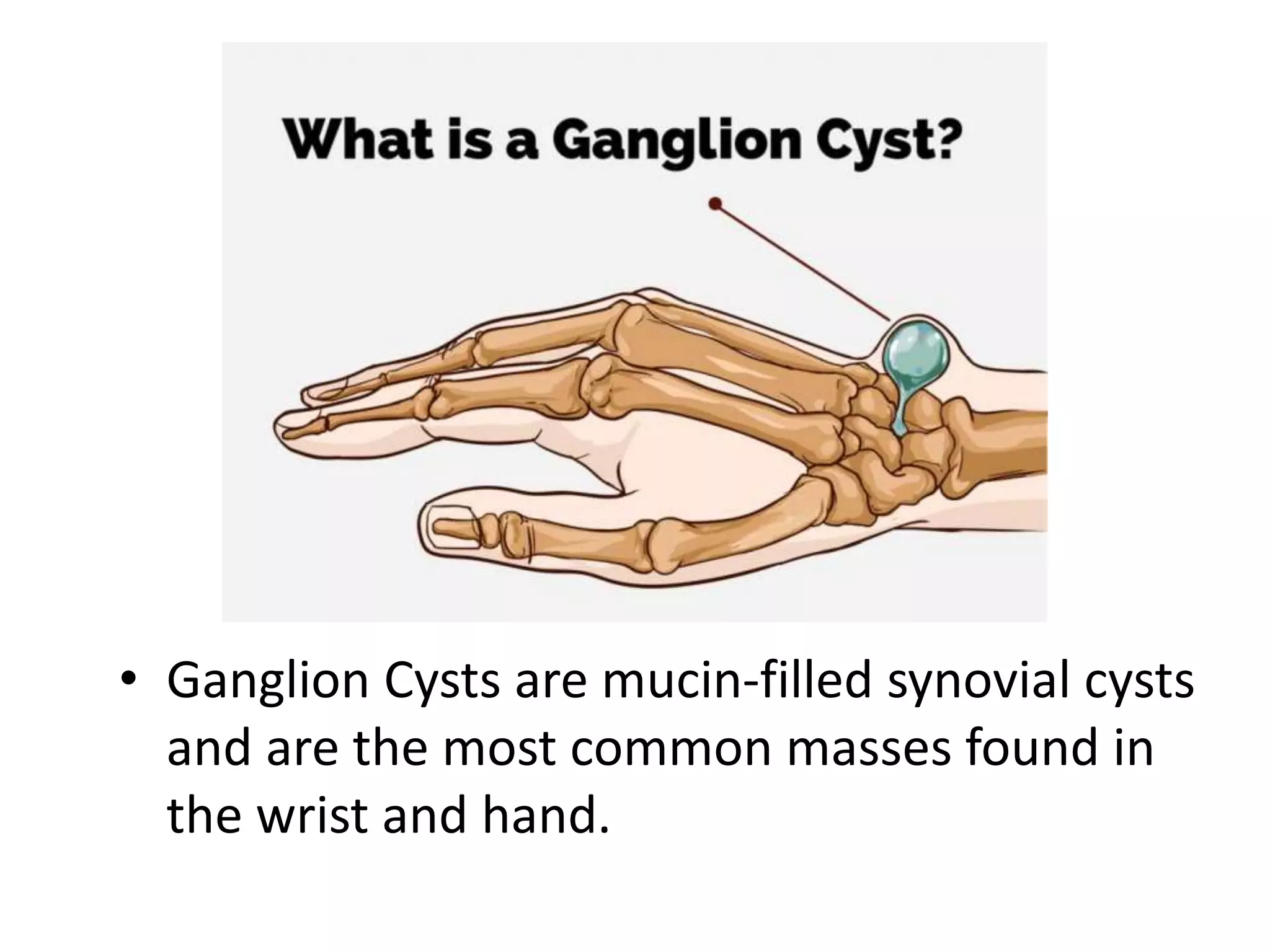 Excision of a ganglion | PPTX