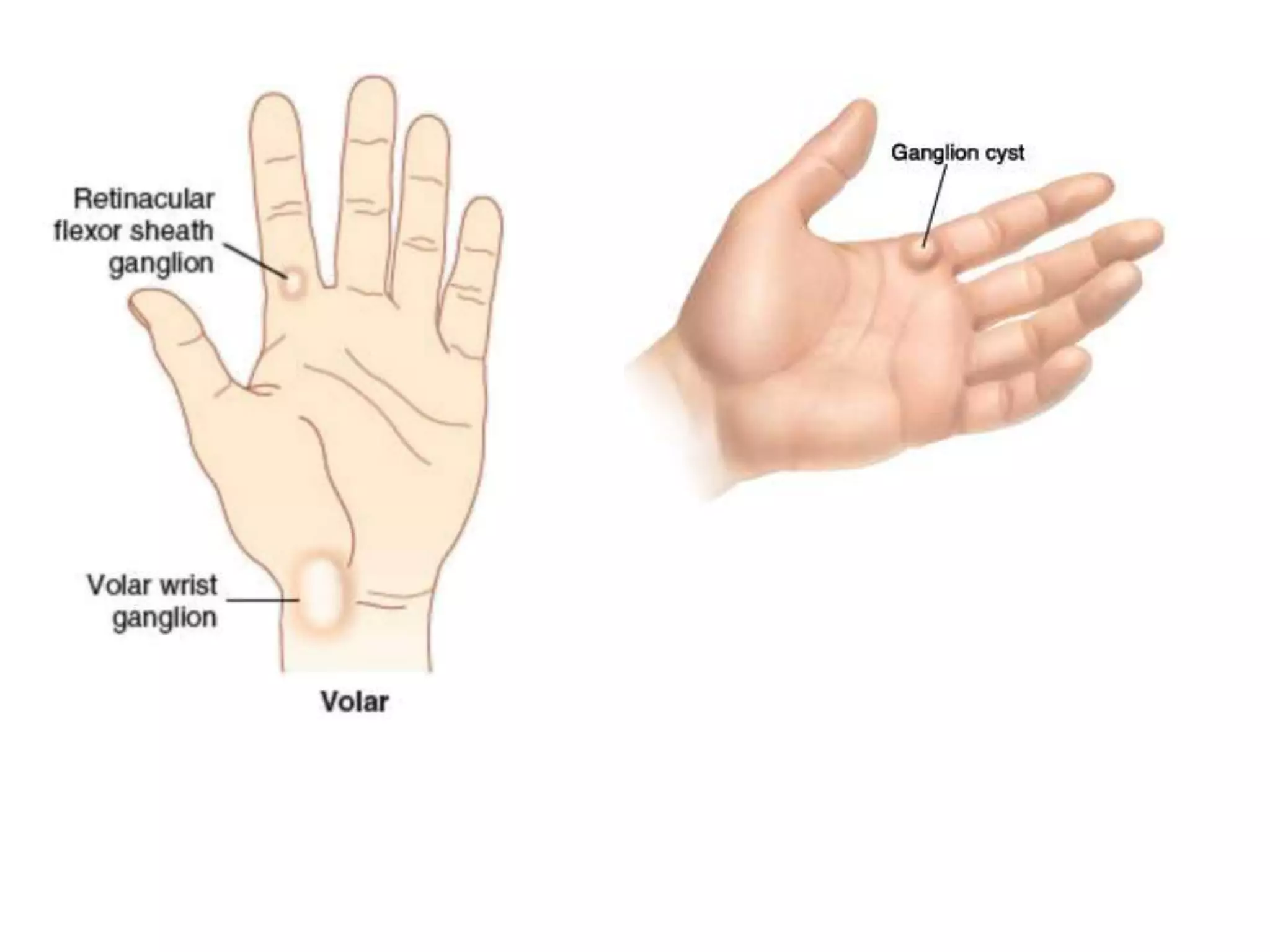 Excision of a ganglion | PPTX