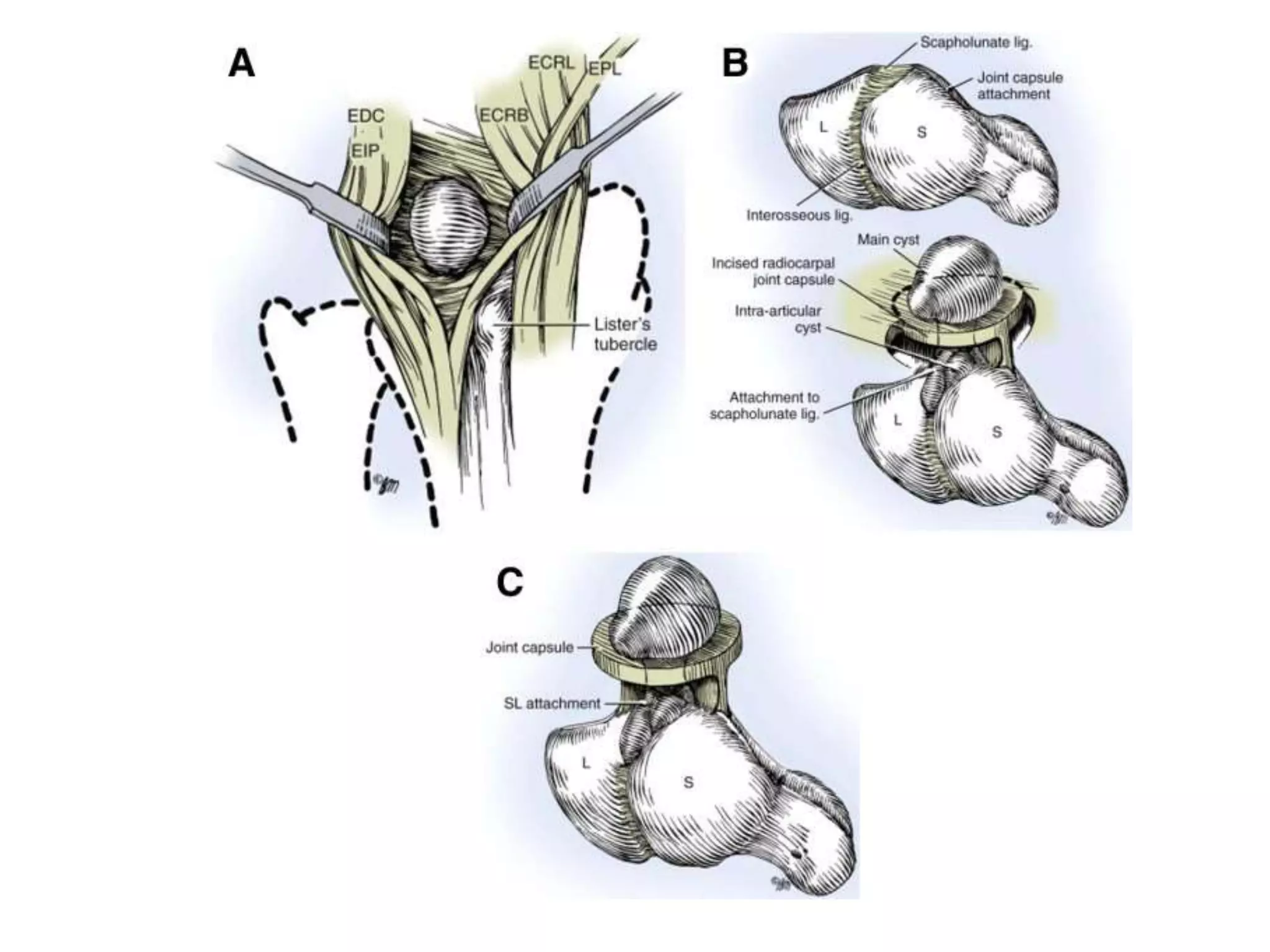 Excision of a ganglion | PPTX