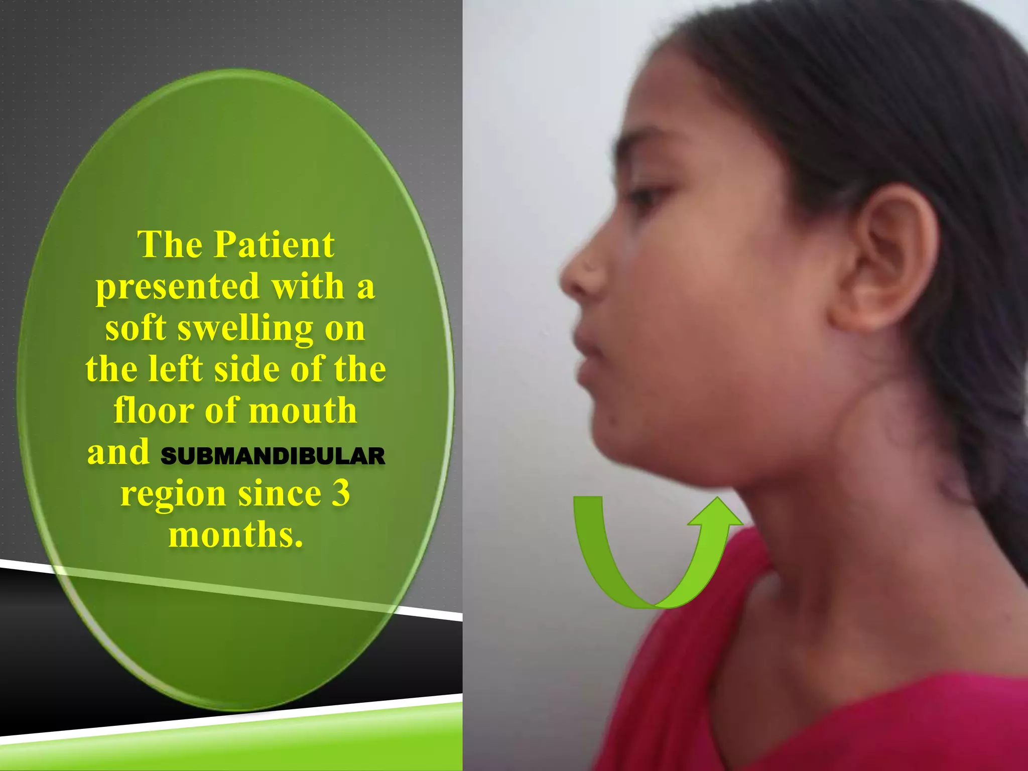 Excision of a plunging ranula | PPTX