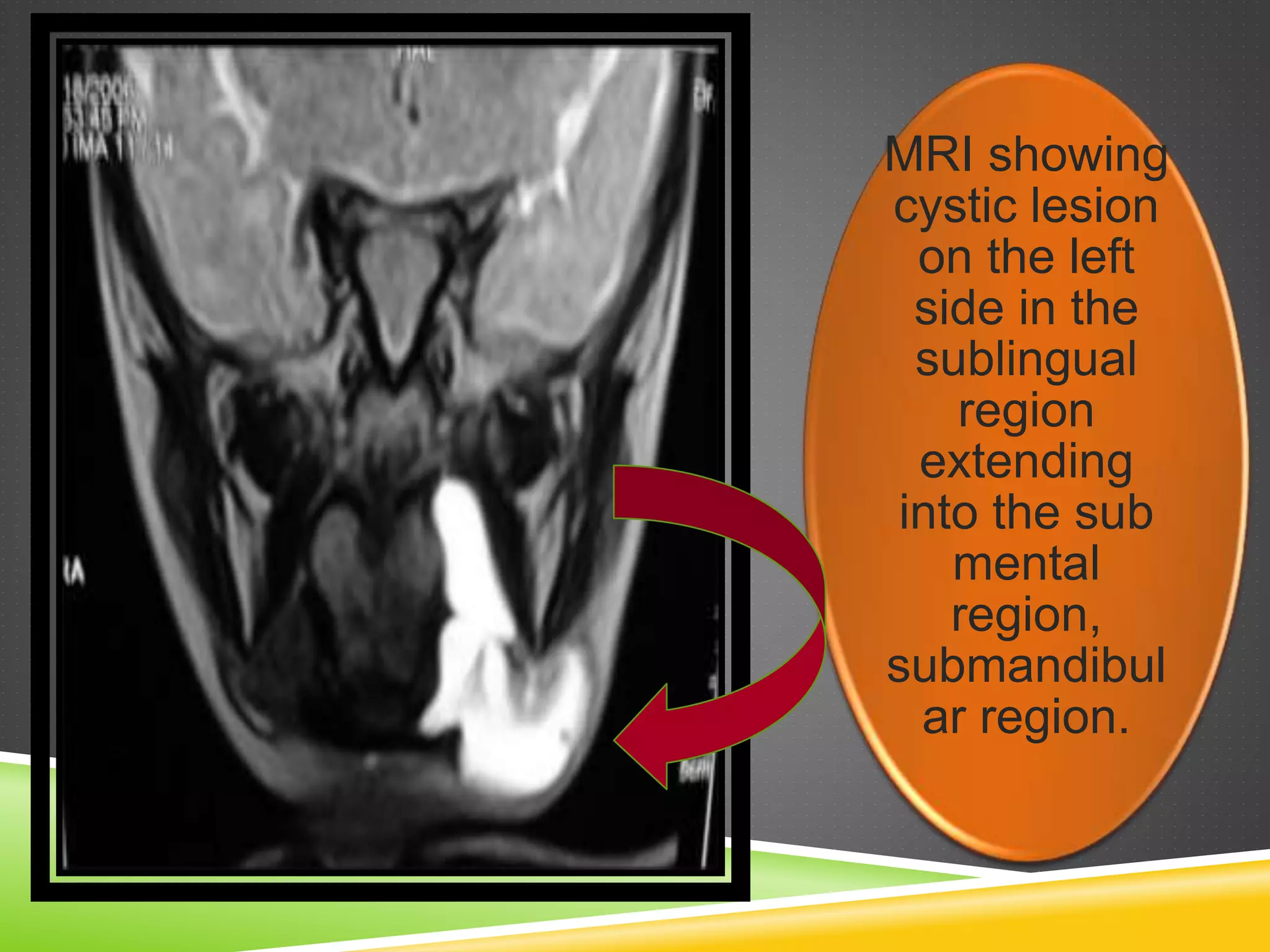 Excision of a plunging ranula | PPTX