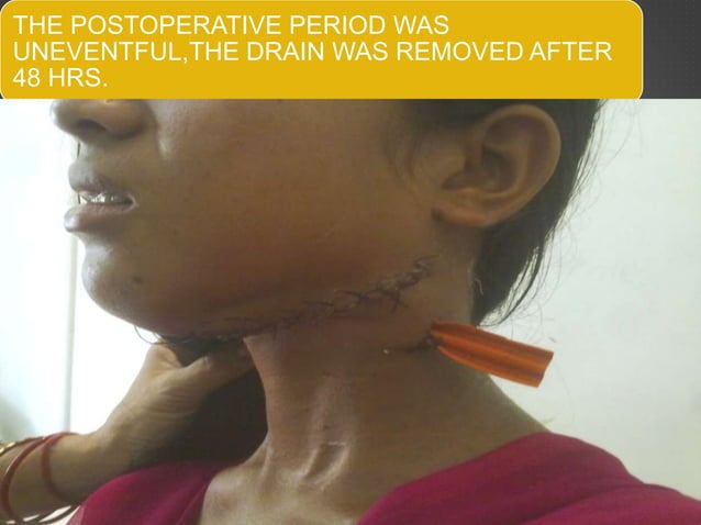 Excision of a plunging ranula | PPTX | Ear, Nose and Throat Conditions ...