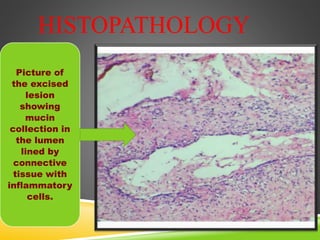 Ranula Histology