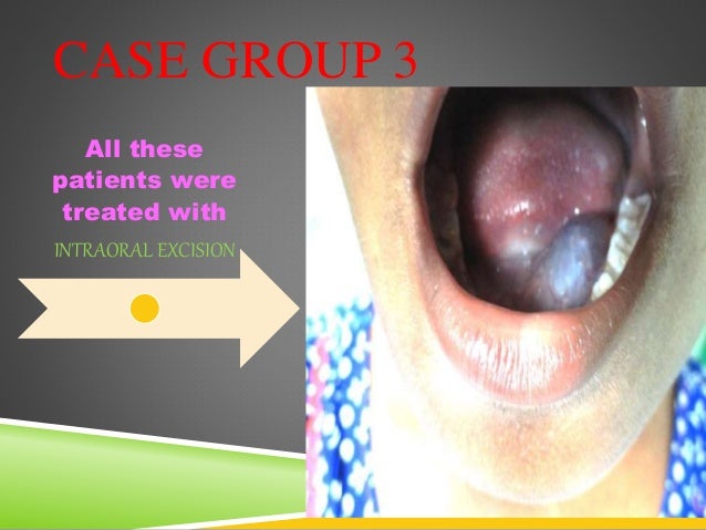 Excision of a plunging ranula