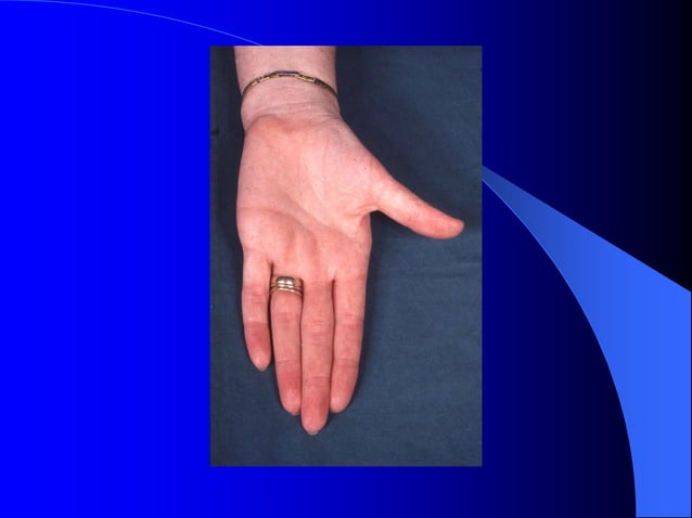 Excision of the trapezium presentation | PPT