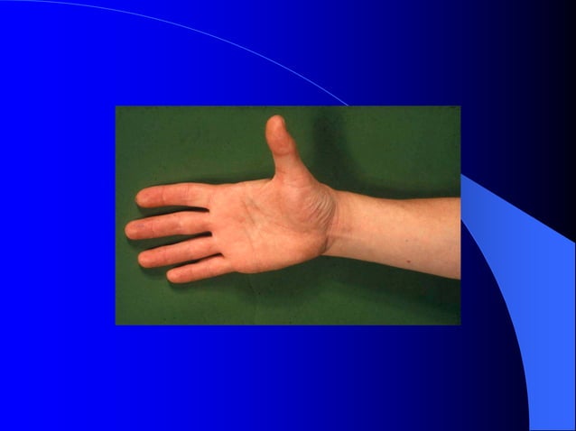 Excision of the trapezium presentation | PPT