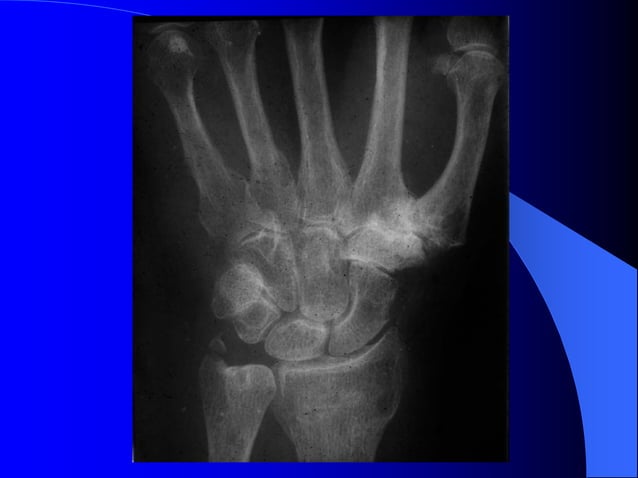 Excision of the trapezium presentation | PDF