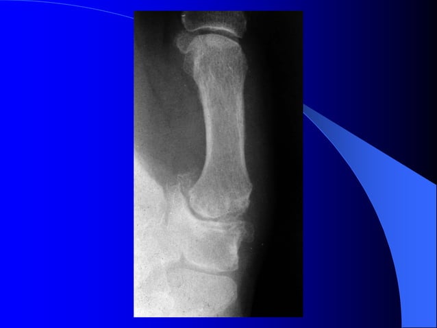 Excision of the trapezium presentation | PDF