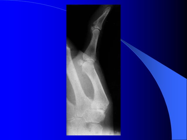 Excision of the trapezium presentation | PDF