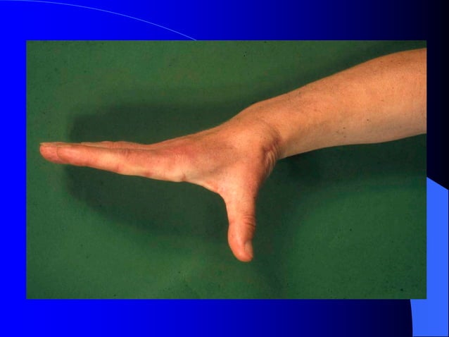 Excision of the trapezium presentation | PDF