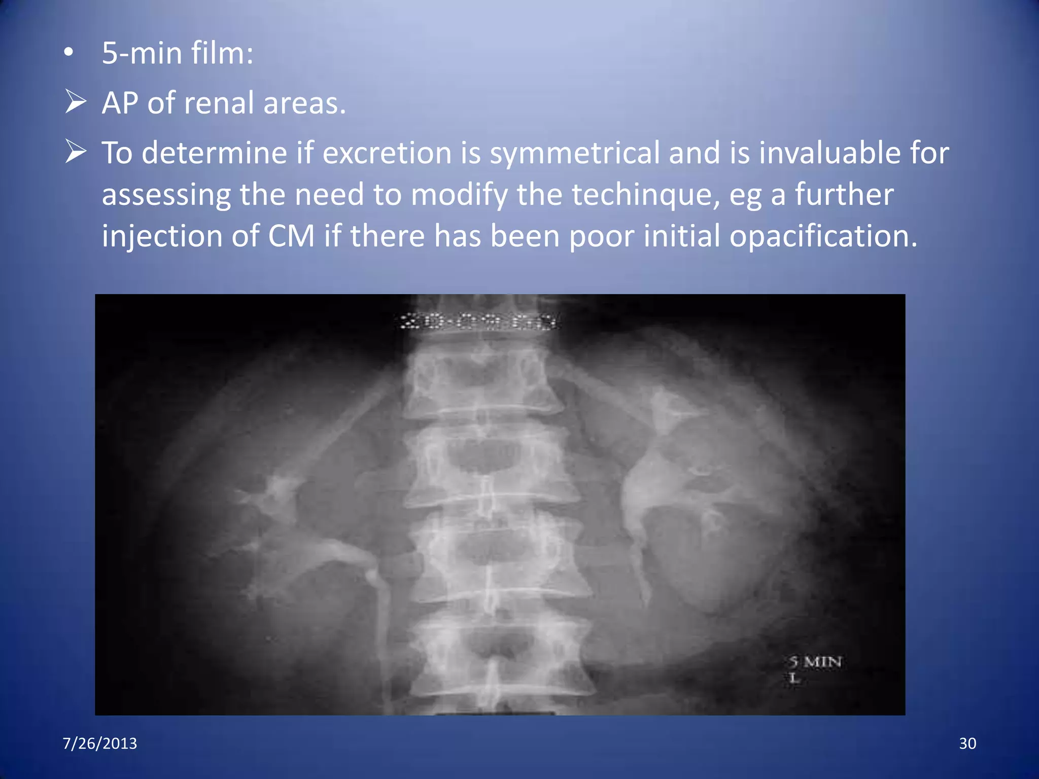 Excretion Urography / Intravenous Urography (IVU) | PPTX