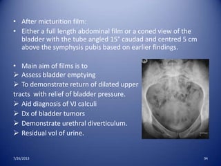 Excretion Urography / Intravenous Urography (IVU) | PPTX