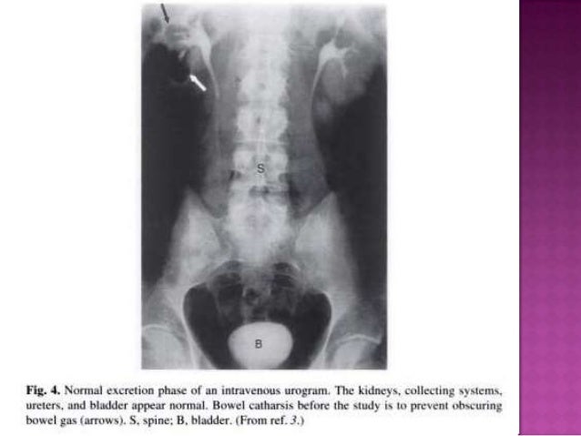 Excretory Urography